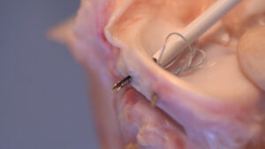 Precision Mr Sutura Menisco All Inside - Orthocare